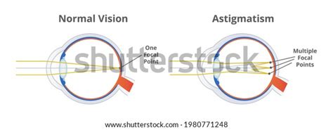 Hundred Eye Refractive Errors Royalty Free Images Stock Photos Pictures Shutterstock