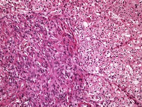 Sarcomatoid Component Within A Chromophobe Rcc Download Scientific Diagram