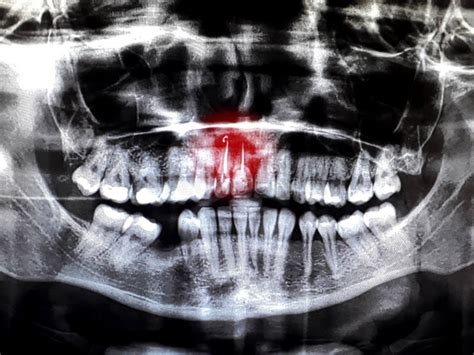 Panoramic Dental X Ray Two Root Canal Treatments With Red Area Stock Image Image Of