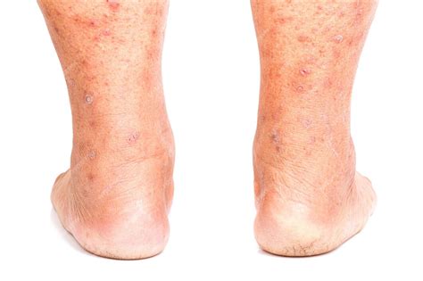 알레르기 피부 여성의 가려운 피부 병변 프리미엄 사진