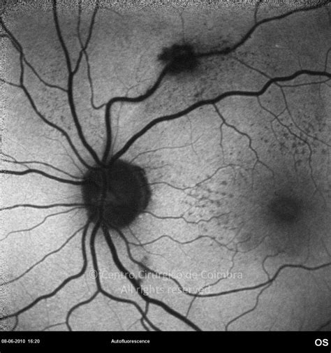 Clinical Case 2 Atlas Rl Eye