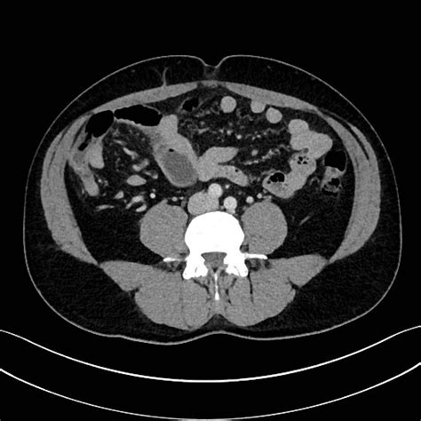Dilated Appendix Radiology Case