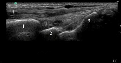 Dorsal Wrist Synovitis Longitudinal Image Sonosite Institute For Point Of Care Ultrasound