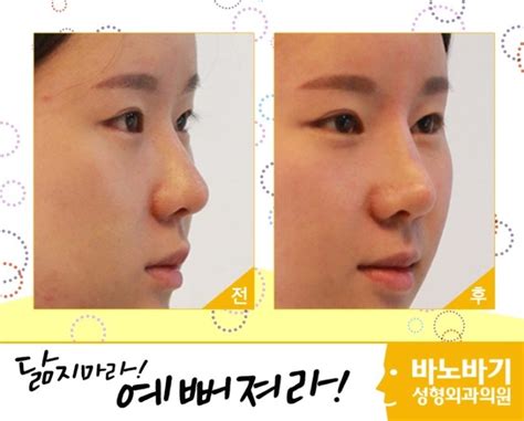 강남 코필러콧대필러붓기콧대필러관리 네이버 블로그