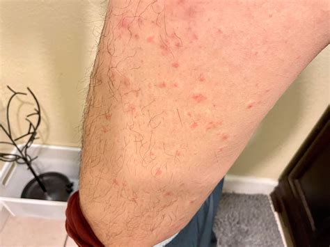 Waking Up With Random Scratch Marks On Shoulders Chest And Stomach R Paranormal