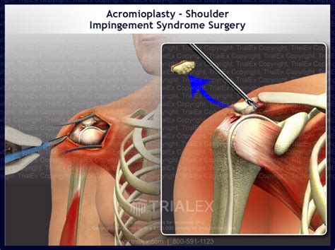 Acromioplasty Shoulder Impingement Syndrome Surgery Trialquest