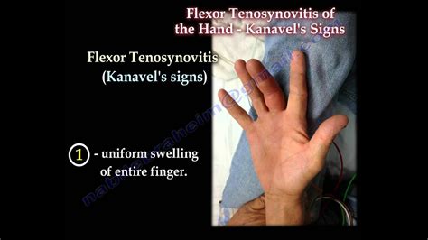 Infectious Flexor Tenosynovitis Flexor Tenosynovitis Is An Infection