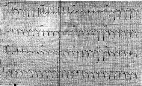 EKG Challenge No Case Conclusion Them Dirty Drugs WashU EM Blog