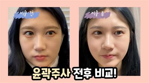 스테로이드 없는 윤곽주사 효과 전후 비교 유지기간 한달 후기 Youtube