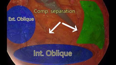 Laparoscopic Endoscopic Anterior Component Separation Youtube