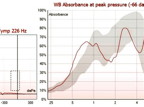 Otosclerosis Tympanogram