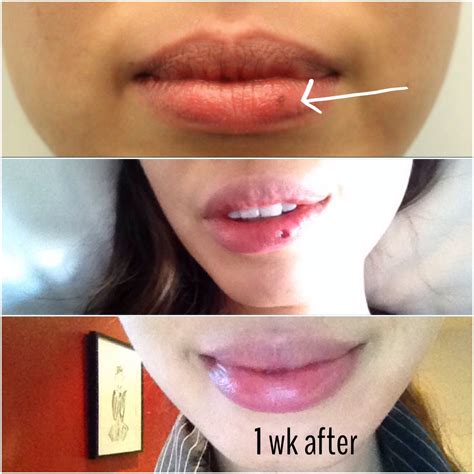 What Is The Meaning Of Mole On Lips