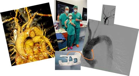 Emiliano Chisci On Linkedin Today Endovascular Aortic Arch Aneurysm Repair Zone 0 Using A Cmd…