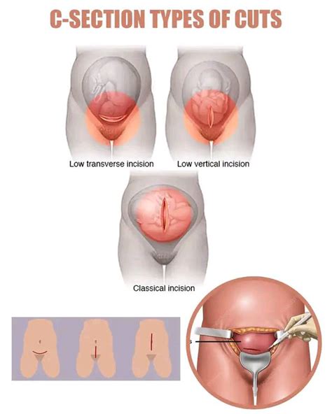 Chibest 🩺 Types Of C Section Incisions What You Need To Know 🤰 A C Section Cesarean Delivery