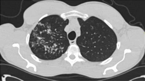 A Systematic Approach To Incidental Lung Nodules A Systematic Approach To Incidental Lung Nodules