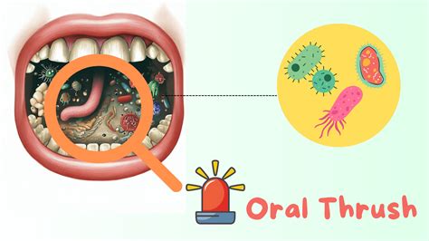 Oral Thrush A Common Fungal Infection Of The Mouth