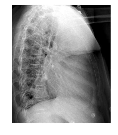 Cxr Lateral Emergucate