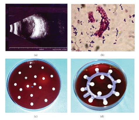 A Patients B Mode Ultrasonography Which Shows Areas Of Increased Download Scientific