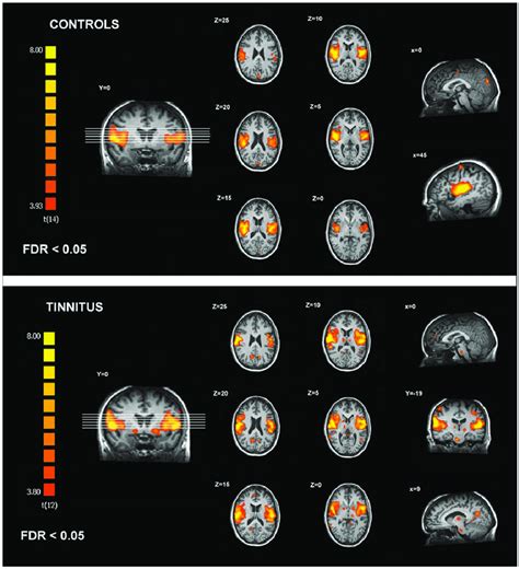 Regions Of The Auditory Resting State Network Identified In Controls Download Scientific