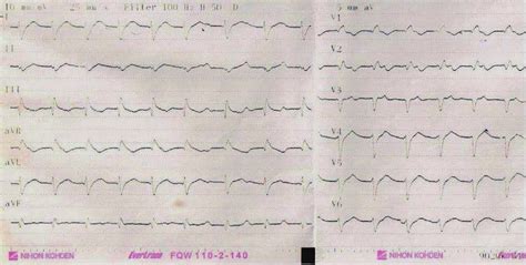 Figure1 Ecg Of Case No 1 Showed Atrial Flutter Complete Right Bundle Download Scientific