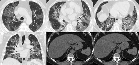 Chest Ct Severity Score And Ctls Non‐enhanced Ct Images In A 57 Download Scientific Diagram