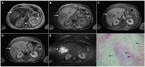 Cholangiocarcinoma Radiology