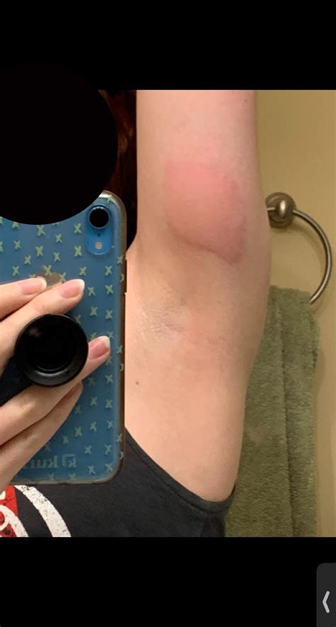 Is It Possible That My Baby Developed Nut Allergy Because Of Me Allergy