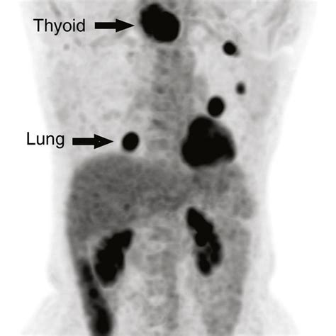 Contrast Enhanced Ct Scan Focused On The Right Thyroid Nodule That Download Scientific Diagram