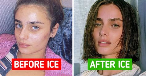 Natural Ways To Get Rid Of Pimples And Make Your Skin Happy Bright Side