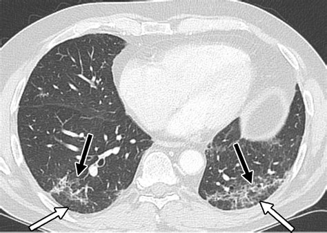 Immune Checkpoint Inhibitor Therapyrelated Pneumonitis Patterns And