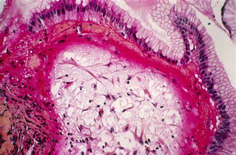 Stomach Ulcer Light Micrograph Stock Image C021 2779 Science Photo Library