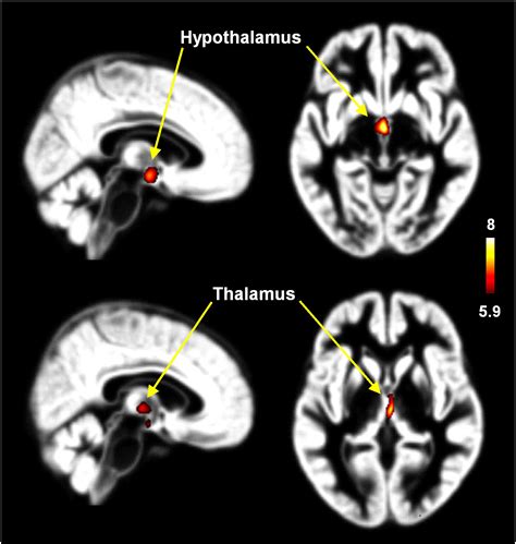 Fig 4 Larger GM Volumes In FTMtranssexuals Comparedwith Female Controls