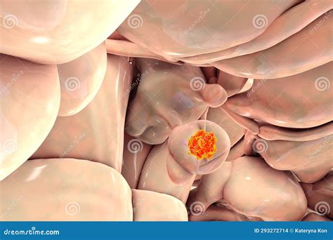 Pituitary Adenoma Cross Section Of Human Brain Cartoon Vector