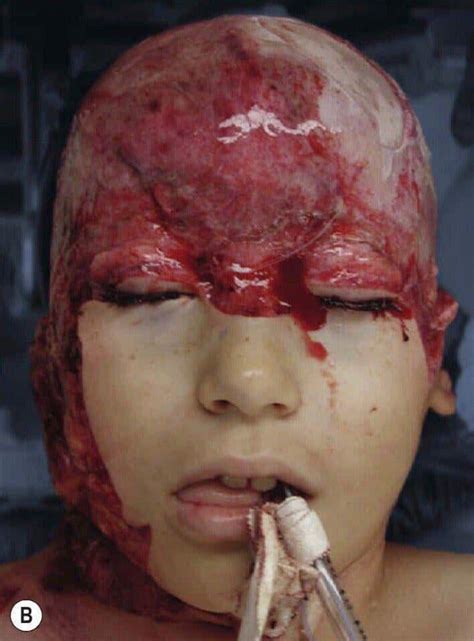 【閲覧注意】遊園地の絶叫マシン、11歳の少女を恐ろしい姿に変える・・・（画像あり） ポッカキットポッカキット