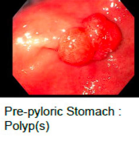 Gastric Polyp Endoloop Esd Scot Lewey Do Facg Fasge Agaf