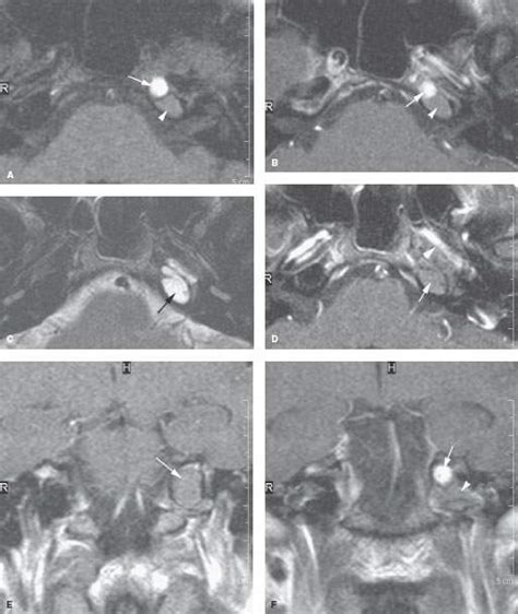 Cholesterol Granuloma Radiology At Nilsa Sutton Blog