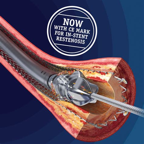 Jetstream™ Atherectomy System Boston Scientific