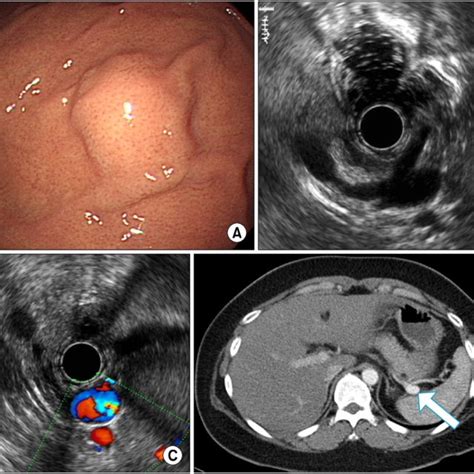 A Endosocpic Finding Of Prepyloric Subepithelial Lesion B Download Scientific Diagram