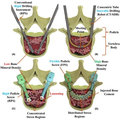 논문 리뷰 Augmented Bridge Spinal Fixation A New Concept For Addressing