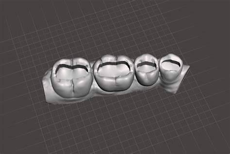 Free Stl File Occlusal Tooth Cavities In Lower Teeth 🦷・3d Print Design