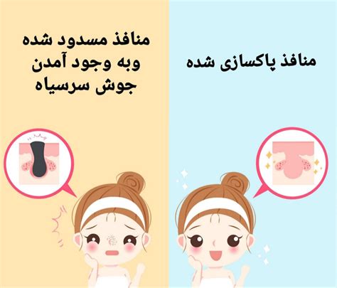 جوش سر سیاه چیست؟ علت و از بین بردن انواع جوش سرسیاه فروشگاه با سحر