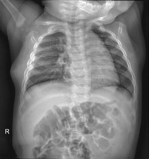 Needle Aspiration Pneumothorax Infant At Amanda Moretz Blog