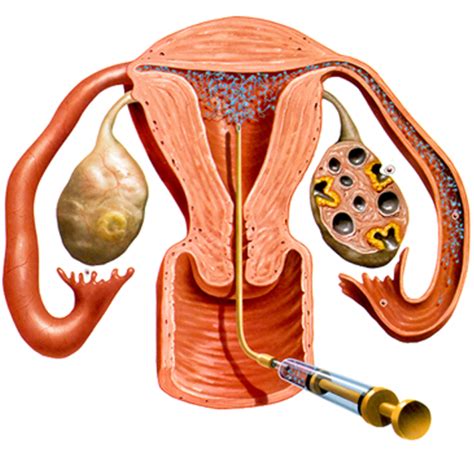 Ovulation Induction Procedure