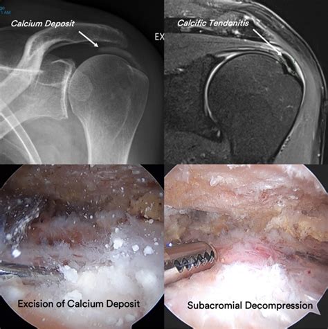 Calcific Tendonitis Shoulder Conditions Sydney Shoulder Unit