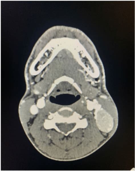 Contrast Enhance Axial Ct Scan Demonstrates Hyperdense Enhancing Mass Download Scientific Diagram