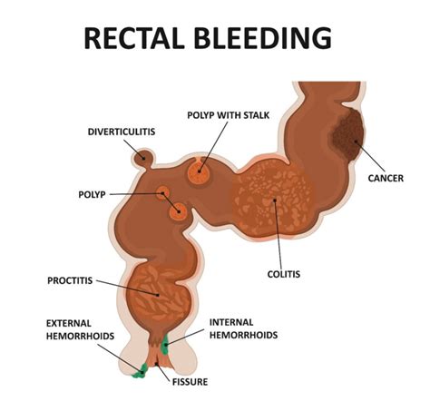 Rectal Bleeding Dr Neeraj Singh Md Facs Fascrs