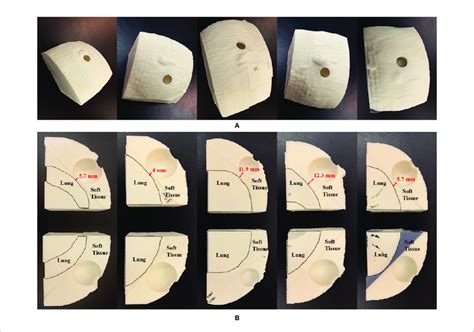 3d Printed Patient Specific Chest Phantom A A Set Of Phantoms