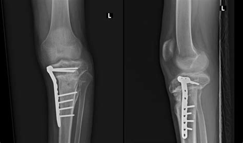 The Radiographic Study Showed The Alignment Of Proximal Tibia After Download Scientific Diagram