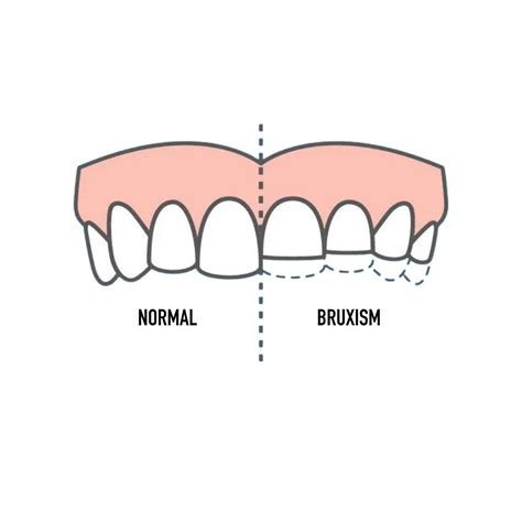 Bruxism And Tmj Quale Vita