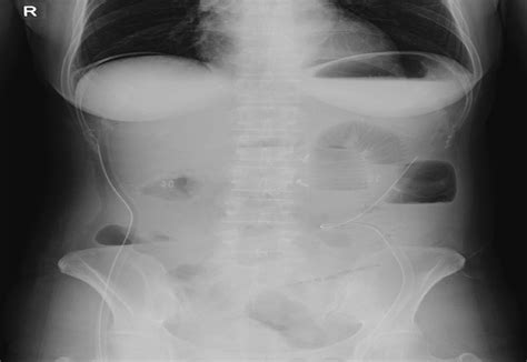 Internal Hernia Through The Mesenteric Opening After Laparos Surgical Laparoscopy Endoscopy